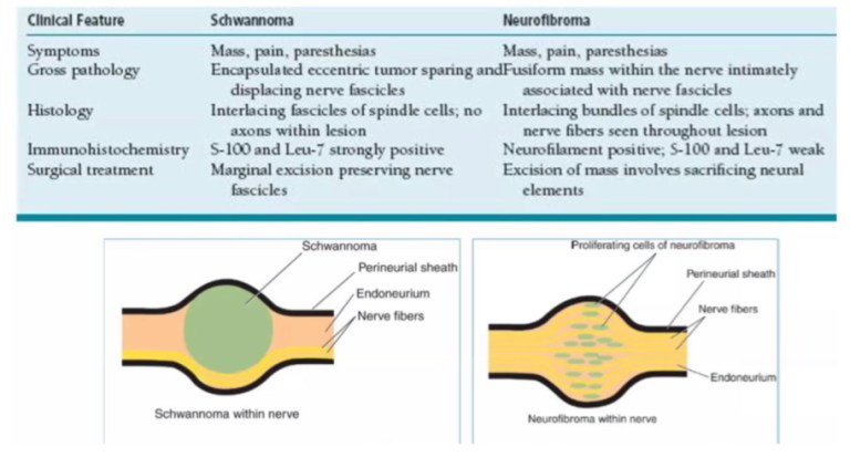 Diagnosis and Treatment of Nerve Sheath Tumors – Ekkapot Jitpun, MD