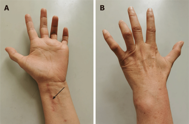 Compressive Neuropathies – Ekkapot Jitpun, MD